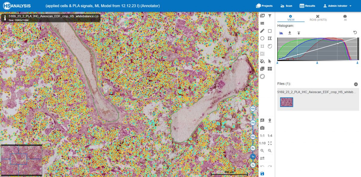 Lung Cancer Diagnostics with AI - HS Analysis GmbH